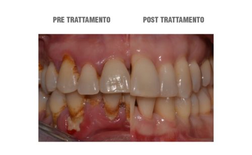 Epatogenesi della parodontite | Biomolecular Diagnostic